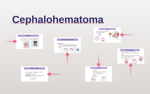 Cephalohematoma by Amanda D on Prezi