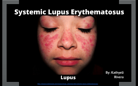 Lupus / Anatomy by Kathyeli Rivera