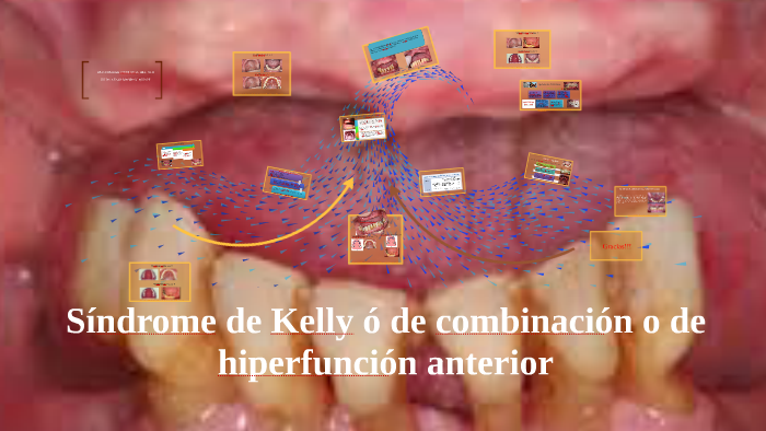 Sindrome de Kelly o combinacion by Julio Cesar Monroy Quispe on Prezi