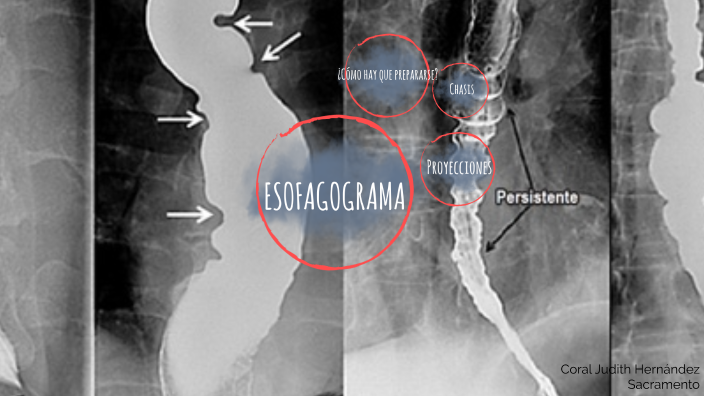 esofagograma by Coral Sacramento on Prezi