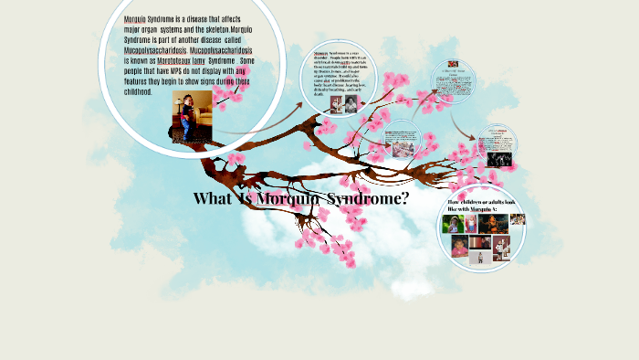 What Is Morquio Syndrome By Mercedes Alvarado On Prezi