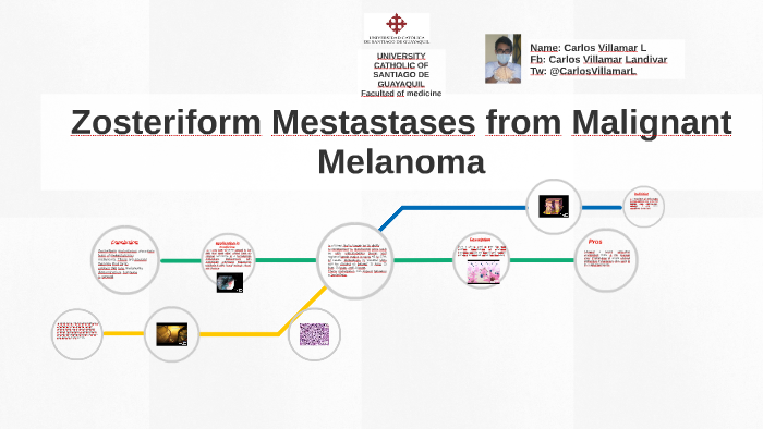 Zosteriform Metastases from Malignant Melanoma by daysy Orozco on Prezi