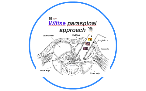 Wiltse paraspinal approach by James Shen on Prezi