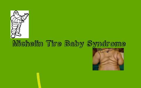 Michelin Tire Baby Syndrome by Korli Alford on Prezi