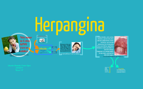 Herpangina In Adults