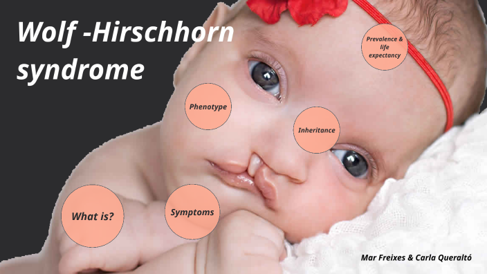 Wolf - Hirschhorn Syndrome by Carla Queraltó Garrido on Prezi