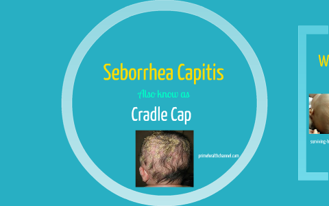 Seborrhea Capitis by Katie Huerter