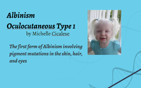 Albinism Oculocutaneous Type 1 by michelle cicalese on Prezi