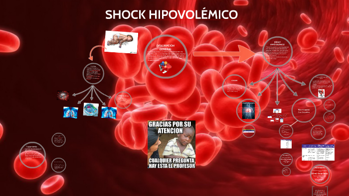 SHOCK HIPOVOLÉMICO by Jair Garcia on Prezi