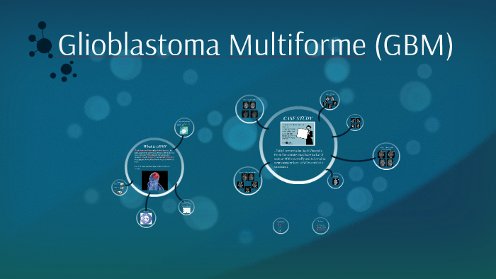 Glioblastoma Multiforme (GBM) by Andrew Michail on Prezi