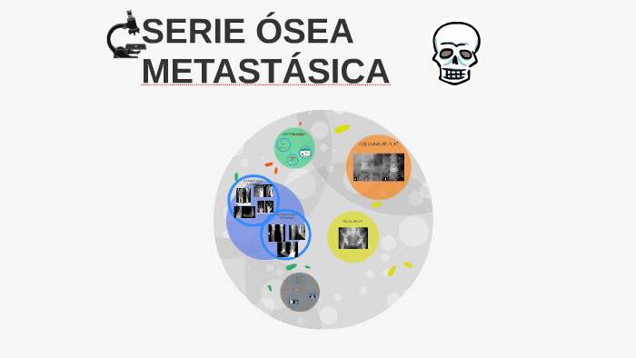 SERIE ÓSEA METASTÁSICA by Maria Castillo on Prezi