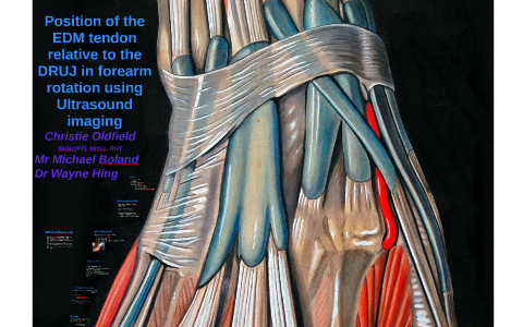 Position of the EDM tendon relative to the DRUJ in forearm r by ...