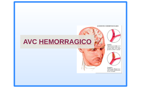 AVC HEMORRAGICO by Camilo Zela on Prezi