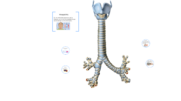 TRAQUEITIS by sandra Diaz on Prezi