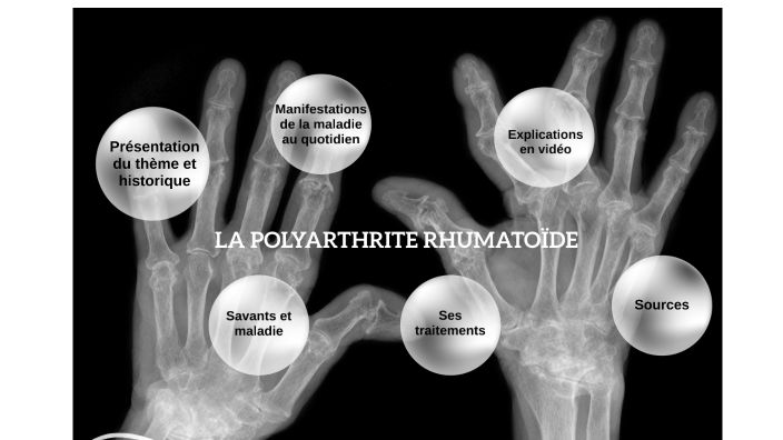Polyarthrite rhumatoïde by e r on Prezi