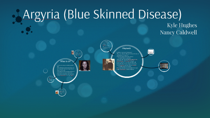Argyria (Blue Skinned Disease) by Nancy Caldwell