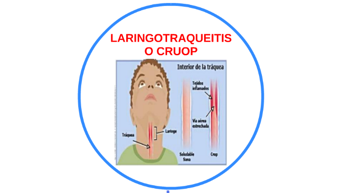 Laringotraqueitis o CRUOP by karen Robles on Prezi