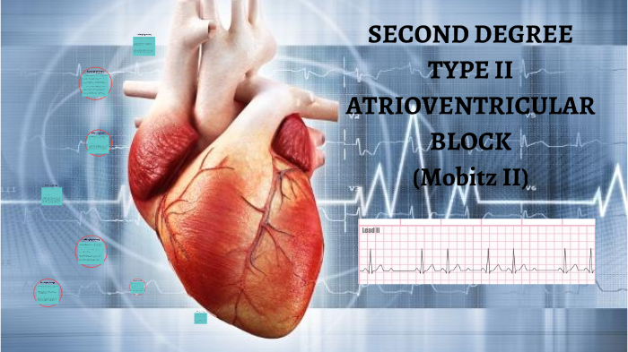 Second degree Type II AV block by Mae DC on Prezi