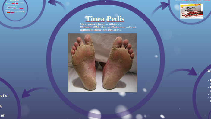 Tinea Pedis by Abhishek Sharma on Prezi