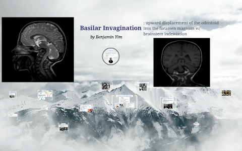 Basilar Invagination by ben yim on Prezi