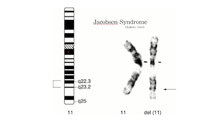 Jacobsen Syndrome by Meghan J on Prezi