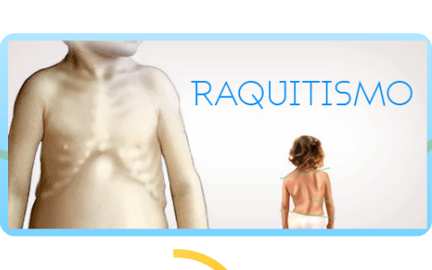 Raquitismo by tomi lorente sanchez on Prezi