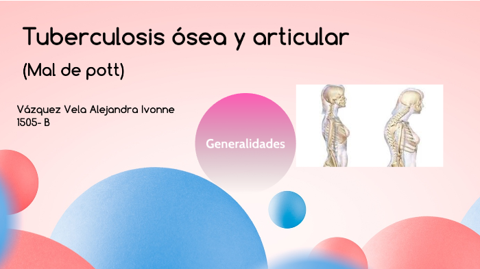 Tuberculosis ósea y articular by Ale Vela on Prezi