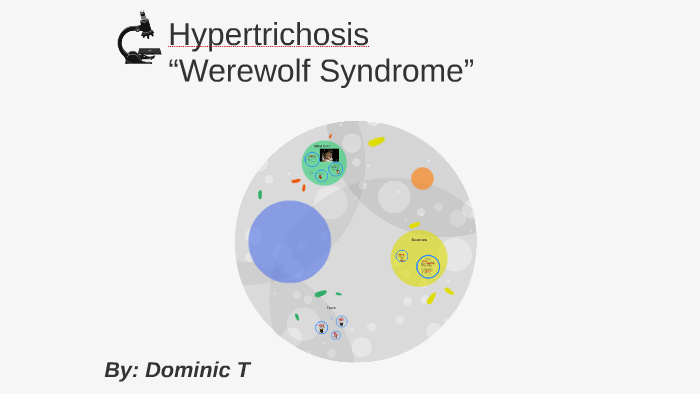 Hypertrichosis “Werewolf Syndrome” by Dominic Tejeda