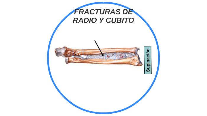 FRACTURAS DE RADIO Y CUBITO by karen rodriguez on Prezi
