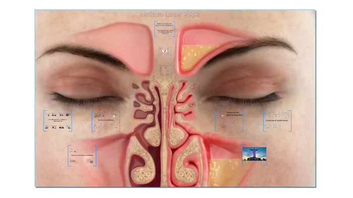 Tumores benignos de nariz y senos paranasales by Alejandra Saer on Prezi
