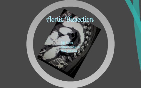 Aortic Dissection by Jeff Biever on Prezi
