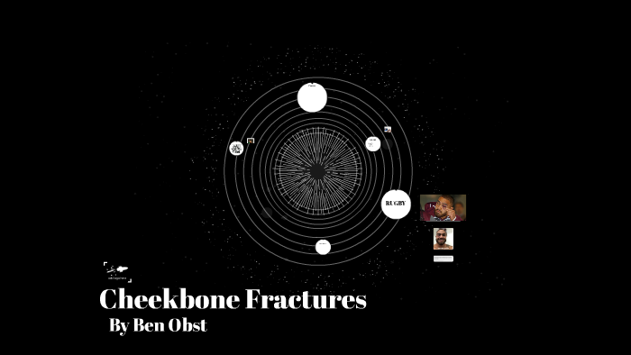 Cheekbone Fractures by Ben Obst on Prezi