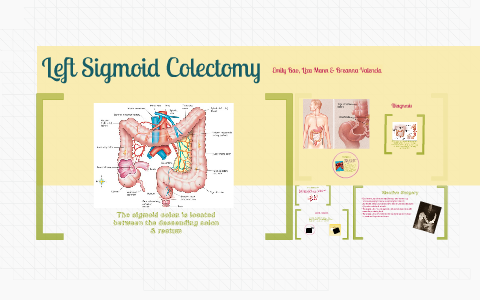 Left Sigmoid Colectomy by Emily Bao on Prezi