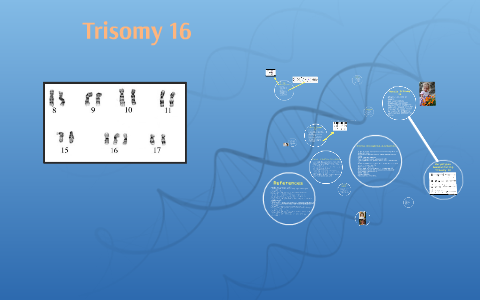 Trisomy 16 by Julie Dunn on Prezi