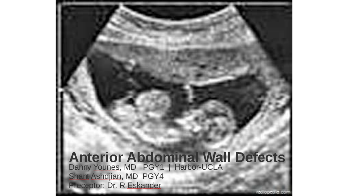 Anterior Abdominal Wall Defects by Danny Younes on Prezi
