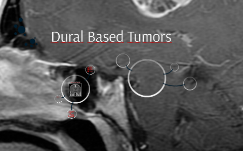 Dural based Tumors by Evin Guilliams on Prezi