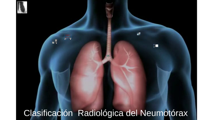 Clasificacion Radiologica del Neumotorax by alberto diaz bracho on Prezi