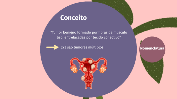 Miomatose Uterina by Isadora Oliveira