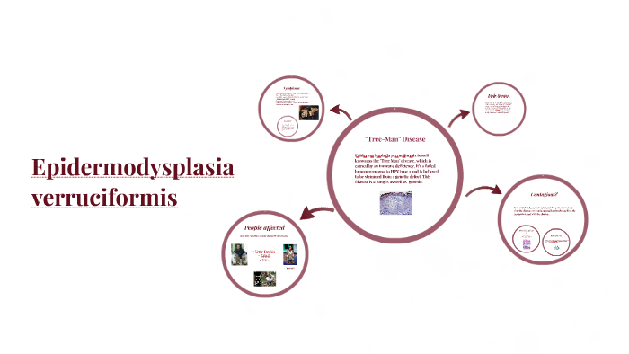 Epidermodysplasia verruciformis by Carlie Cristofaro on Prezi