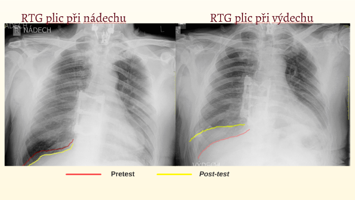 RTG plic pří nádechu by Artem Vetkasov on Prezi