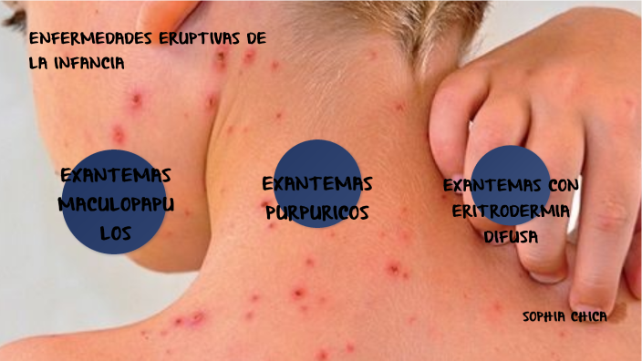 ENFERMEDADES ERUPTIVAS DE LA INFANCIA by sophia chica on Prezi