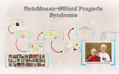 Hutchinson Gilford Progeria Syndrome by on Prezi