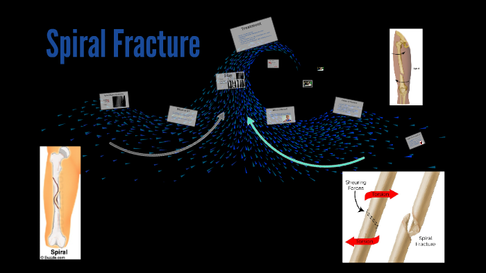 Spiral Bone Fractures by on Prezi