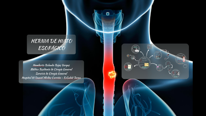 Hernia de Hiato Esofágico by Humberto Rolando Rojas Vargas on Prezi