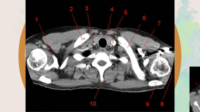 TOMOGRAFIA DE TORAX NORMAL Y PATOLOGICO by katiuska Cervantes on Prezi