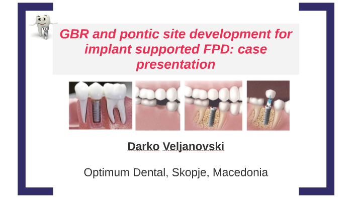 GBR and pontic site development for implant supported FPD: case ...