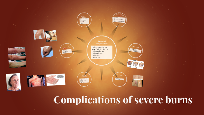 Complications of severe burns by Cerys Chau