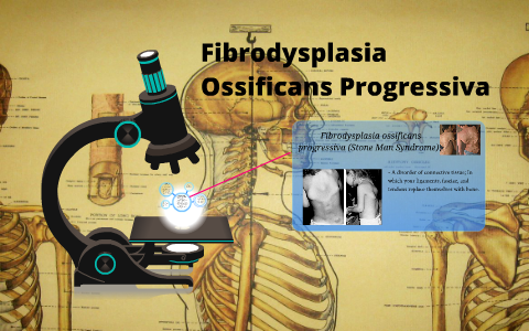 Fibrodysplasia ossificans progressiva (Stone Man Syndrome) by Derwin ...