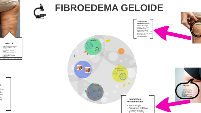 FIBROEDEMA GELOIDE by Kim Oliveira