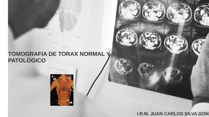 TOMOGRAFIA DE TORAX NORMAL Y PATOLOGICO by ELIZABETH AROSEMENA on Prezi